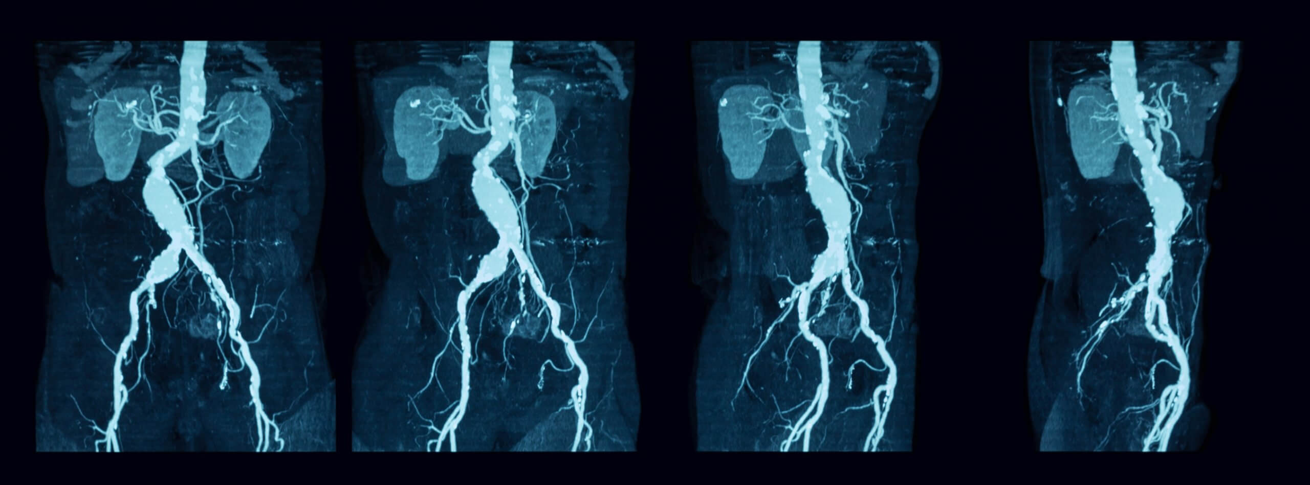 Pulmonary angiography | PHA